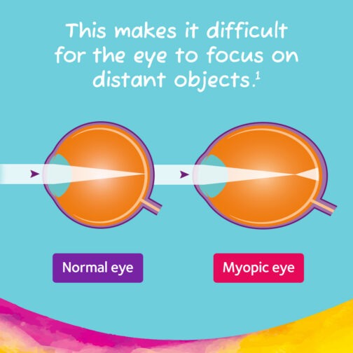 Myopia control – Camarena Porter Optometrist (Spectacle World)