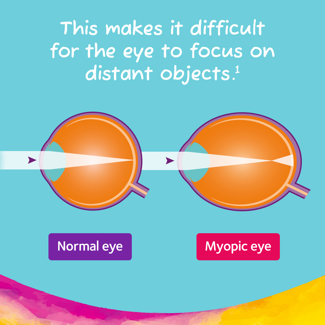 Myopia control – Camarena Porter Optometrist (Spectacle World)
